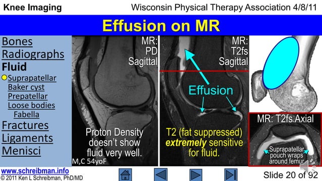 Knee Imaging narrated MSK Radiology Lecture | PPT