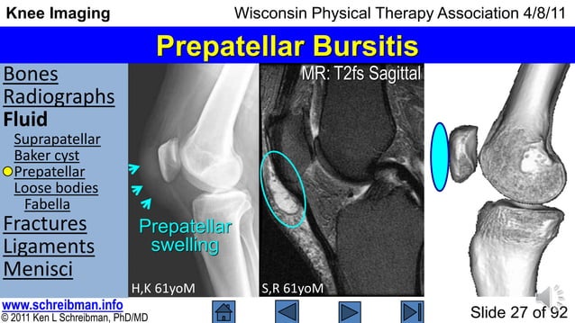 Knee Imaging narrated MSK Radiology Lecture | PPT