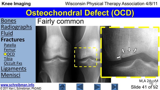 Knee Imaging narrated MSK Radiology Lecture | PPT