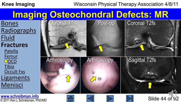 Knee Imaging narrated MSK Radiology Lecture | PPT