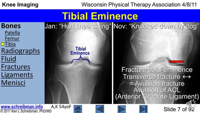 Knee Imaging narrated MSK Radiology Lecture | PPT