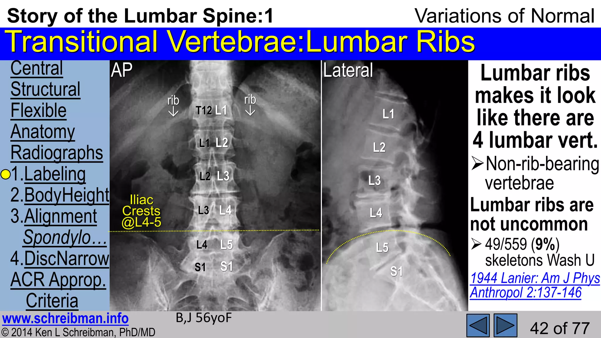 Story of the Lumbar Spine:1 Normal Variations | PPT