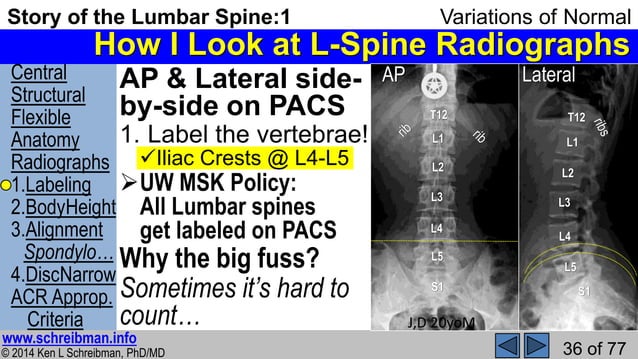 Story of the Lumbar Spine:1 Normal Variations | PPT