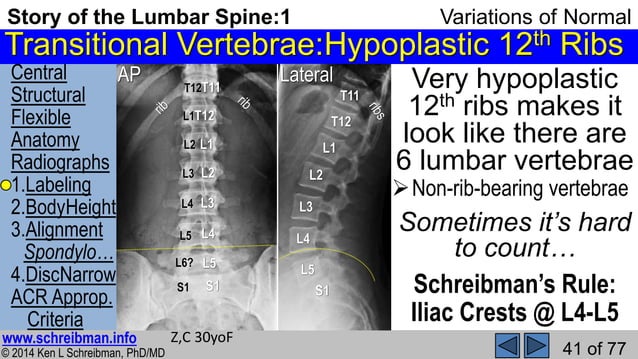 Story of the Lumbar Spine:1 Normal Variations | PPT