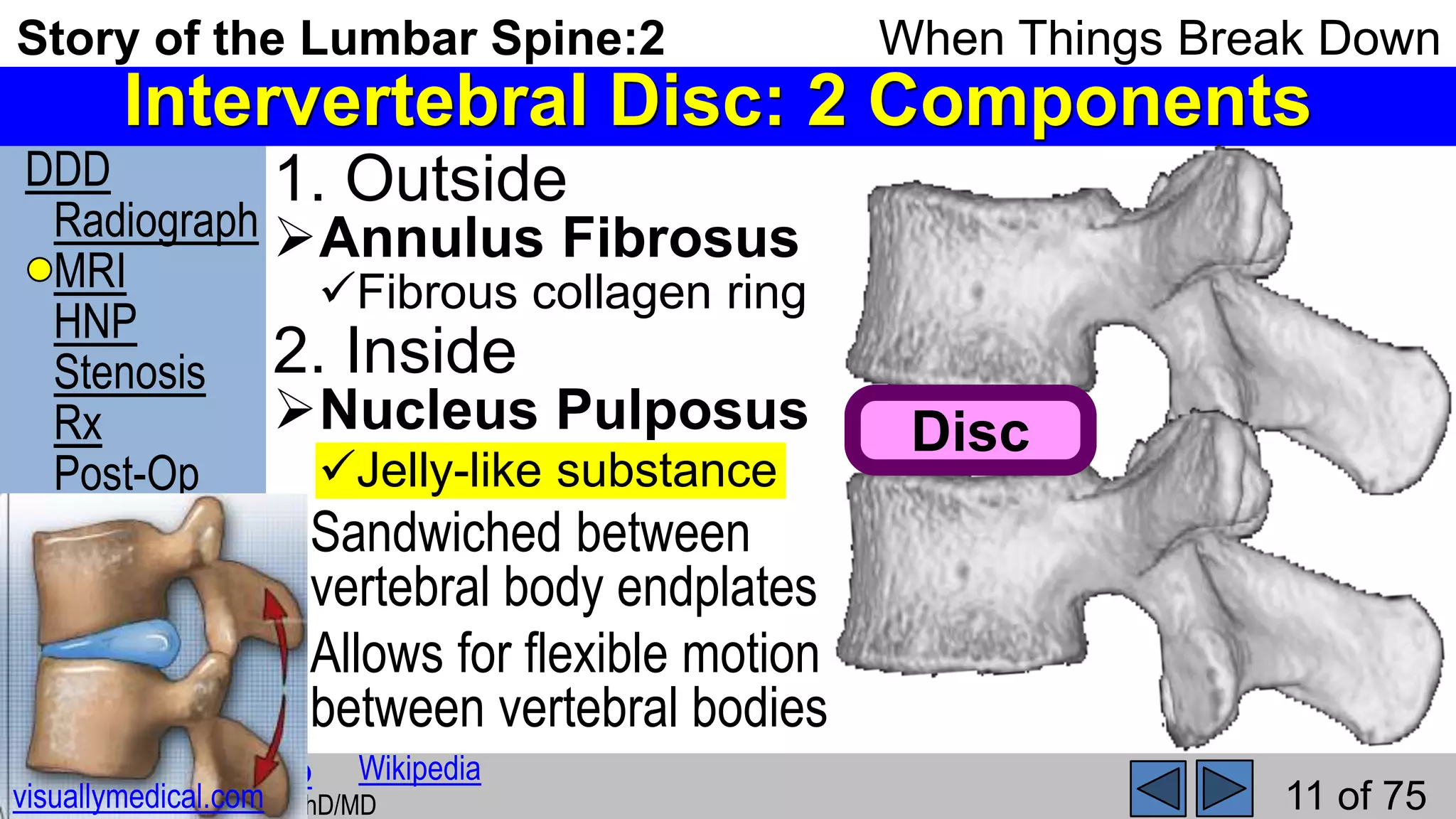 Story of the Lumbar Spine 2 When Things Break Down | PPSX