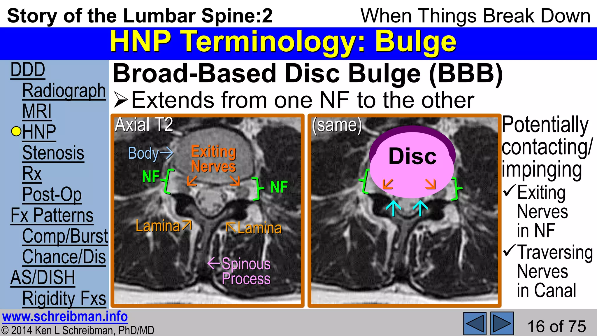 Story of the Lumbar Spine 2 When Things Break Down | PPSX