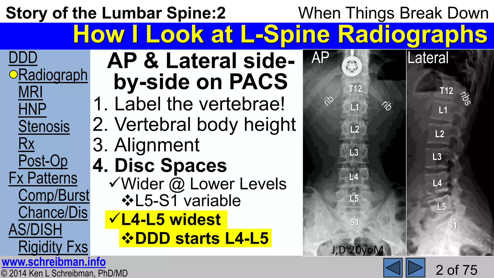 Story of the Lumbar Spine 2 When Things Break Down | PPSX