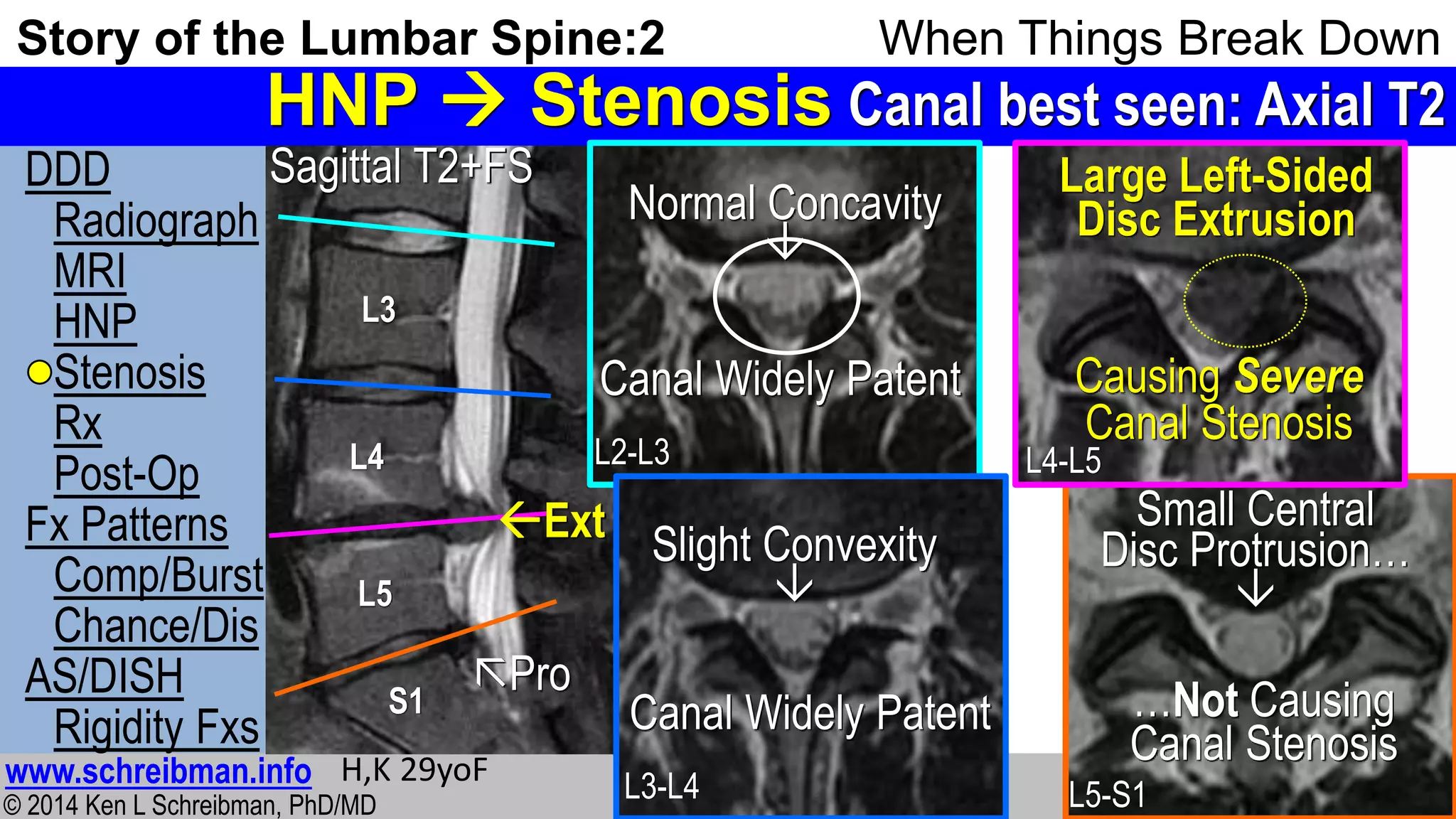 Story of the Lumbar Spine 2 When Things Break Down | PPSX