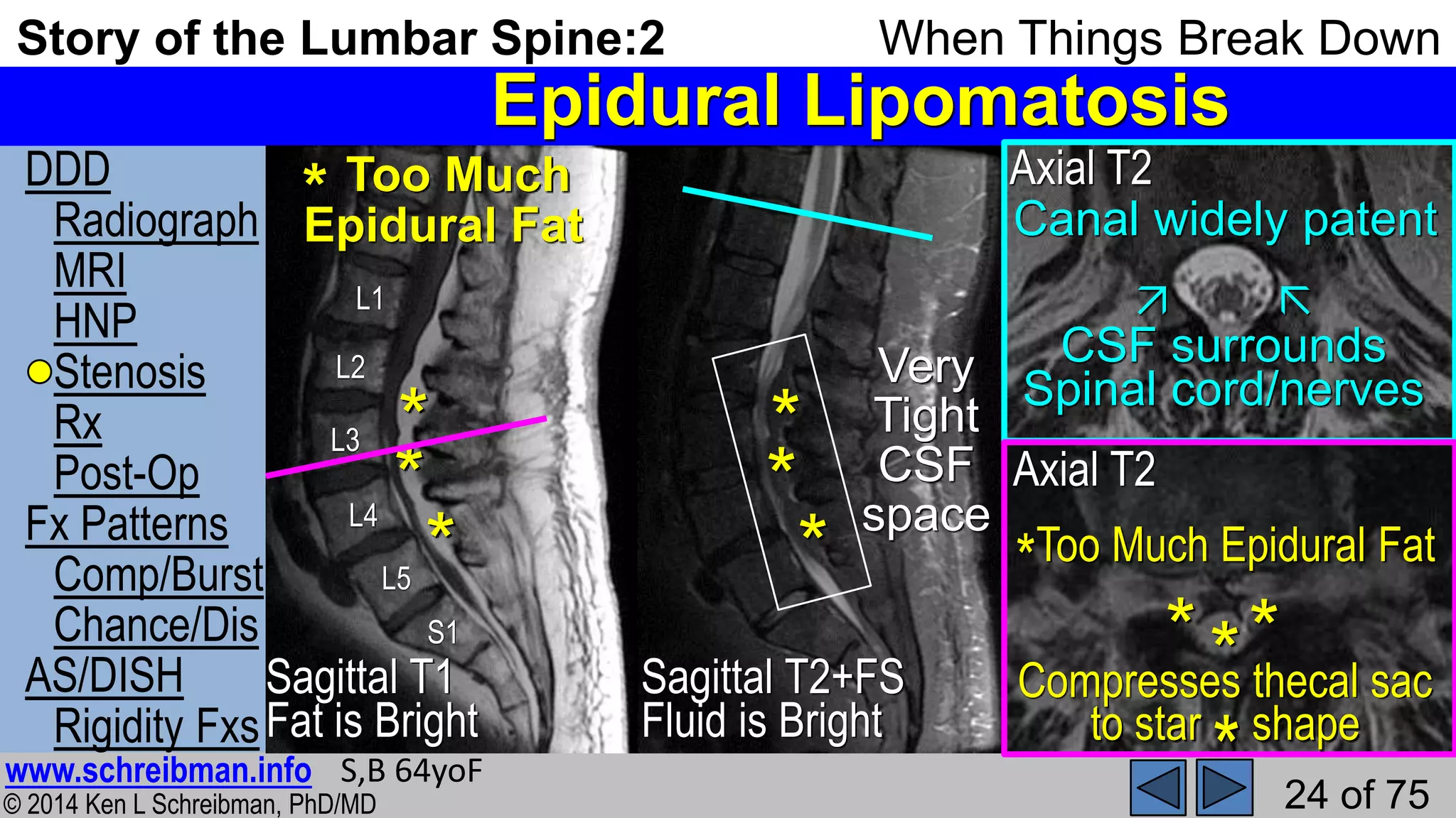 Story of the Lumbar Spine 2 When Things Break Down | PPSX