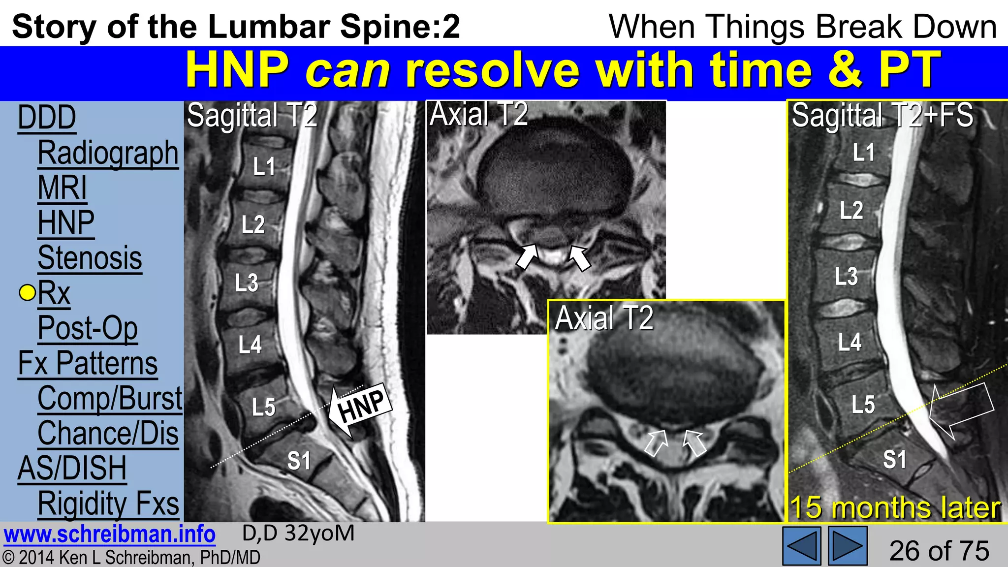 Story of the Lumbar Spine 2 When Things Break Down | PPSX