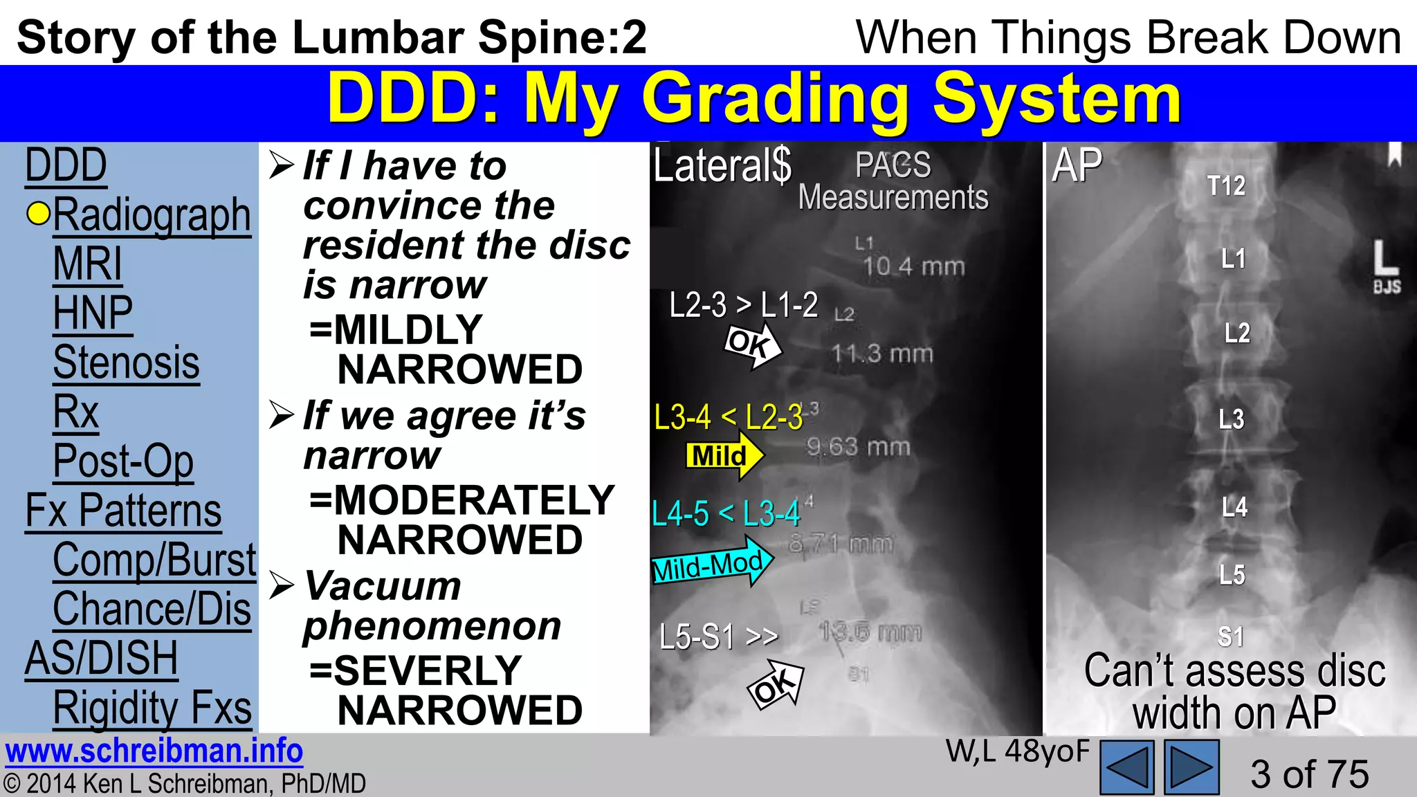 Story of the Lumbar Spine 2 When Things Break Down | PPSX