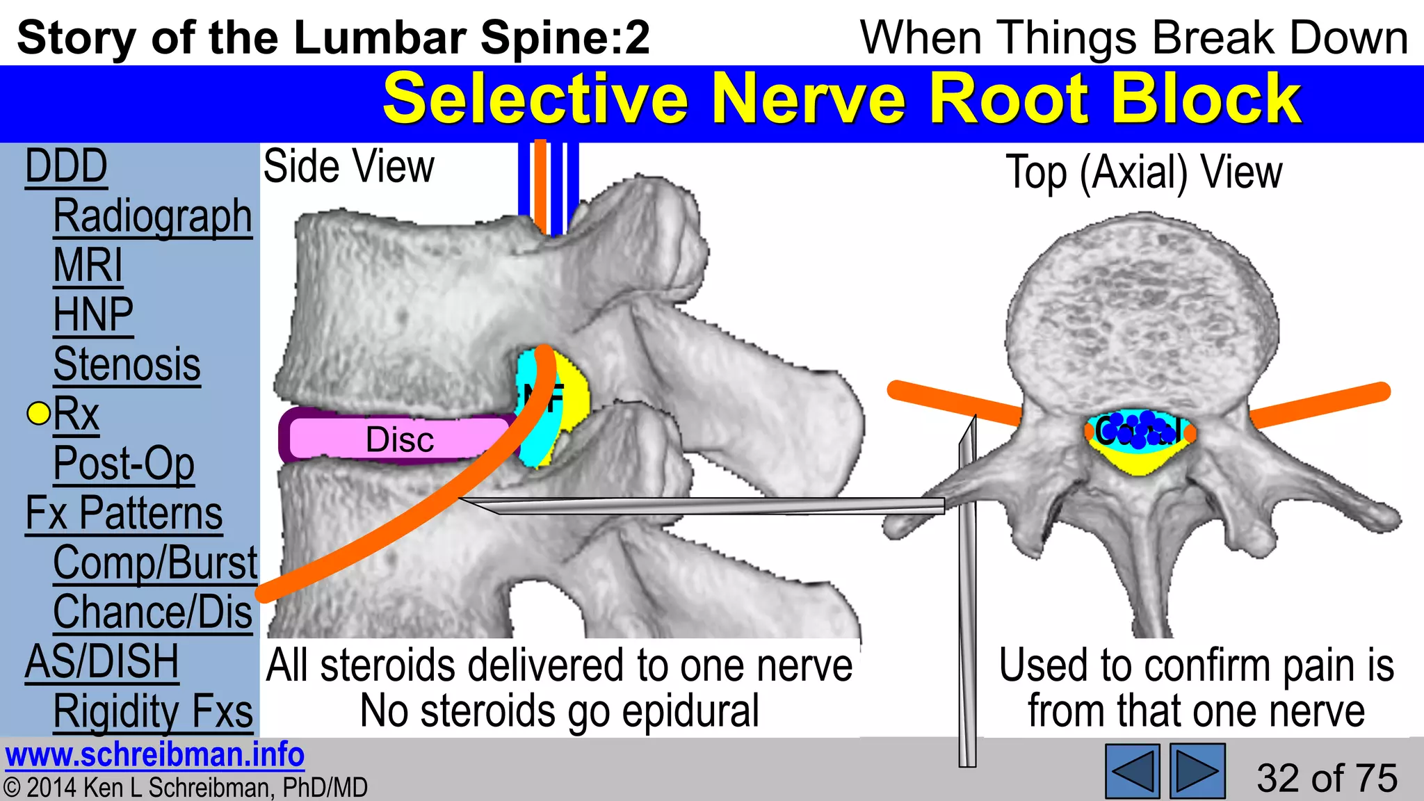 Story of the Lumbar Spine 2 When Things Break Down | PPSX