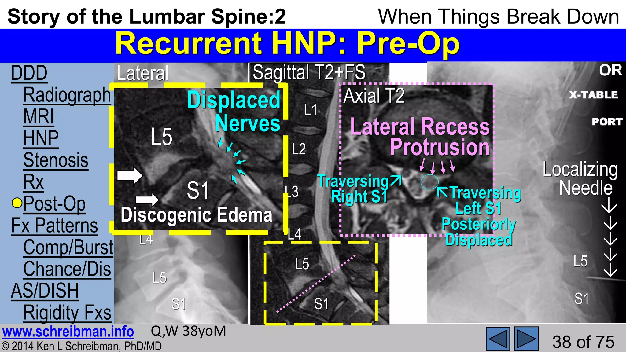 Story of the Lumbar Spine 2 When Things Break Down | PPSX