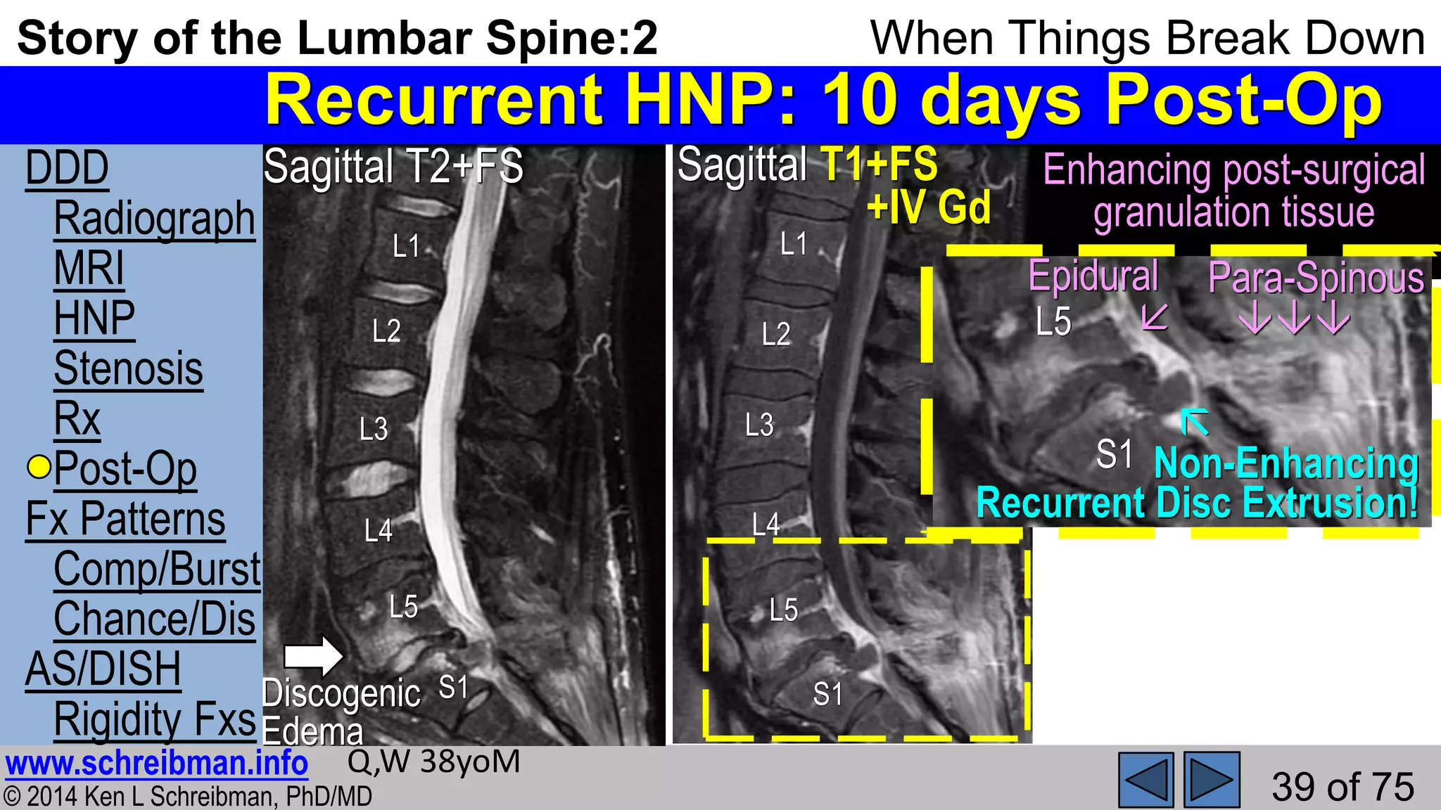 Story of the Lumbar Spine 2 When Things Break Down | PPSX