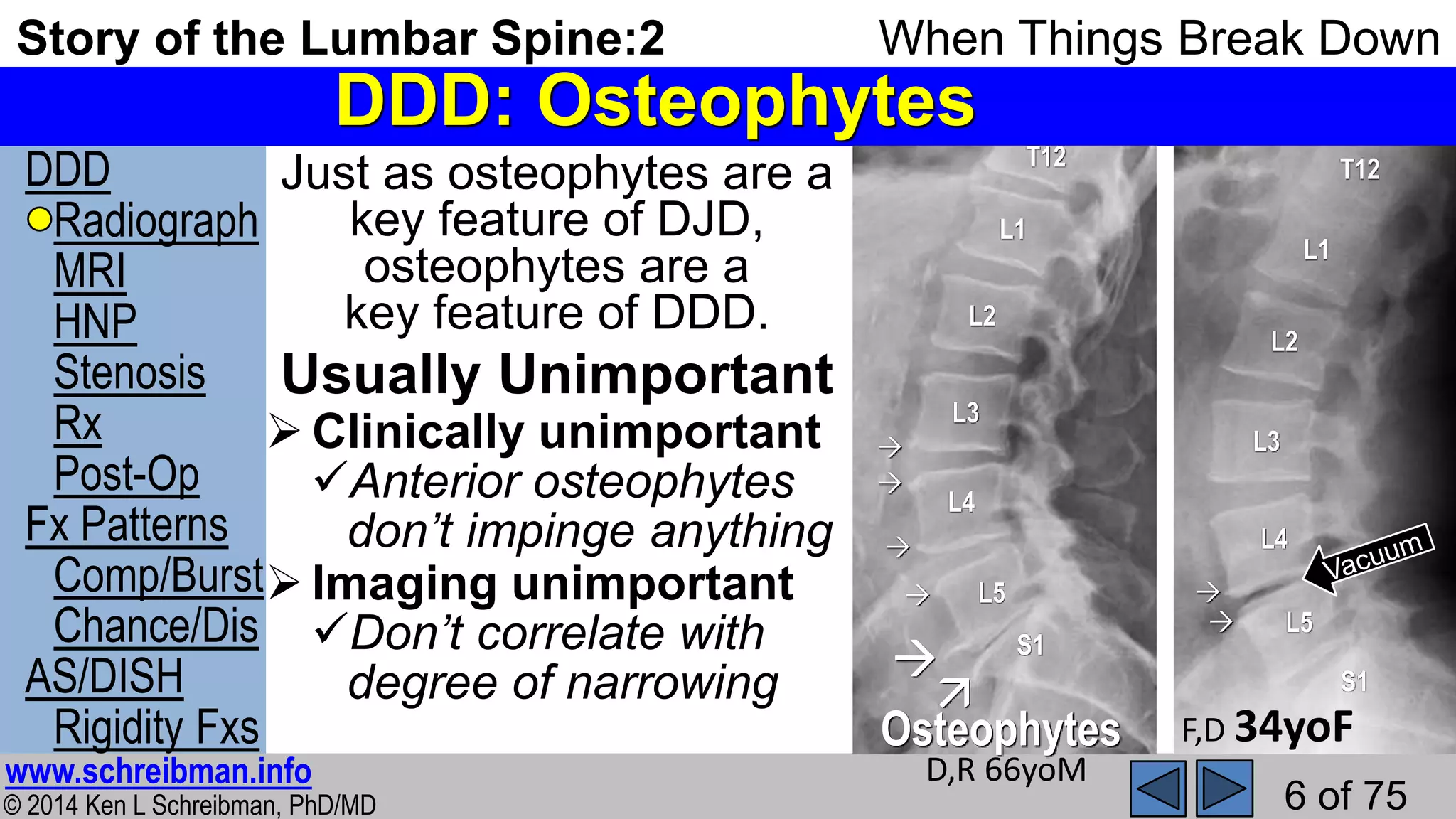 Story of the Lumbar Spine 2 When Things Break Down | PPSX