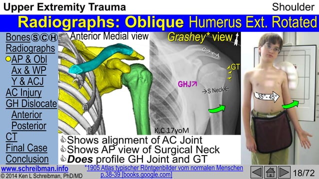 Upper Extremity Trauma Shoulder | PPT