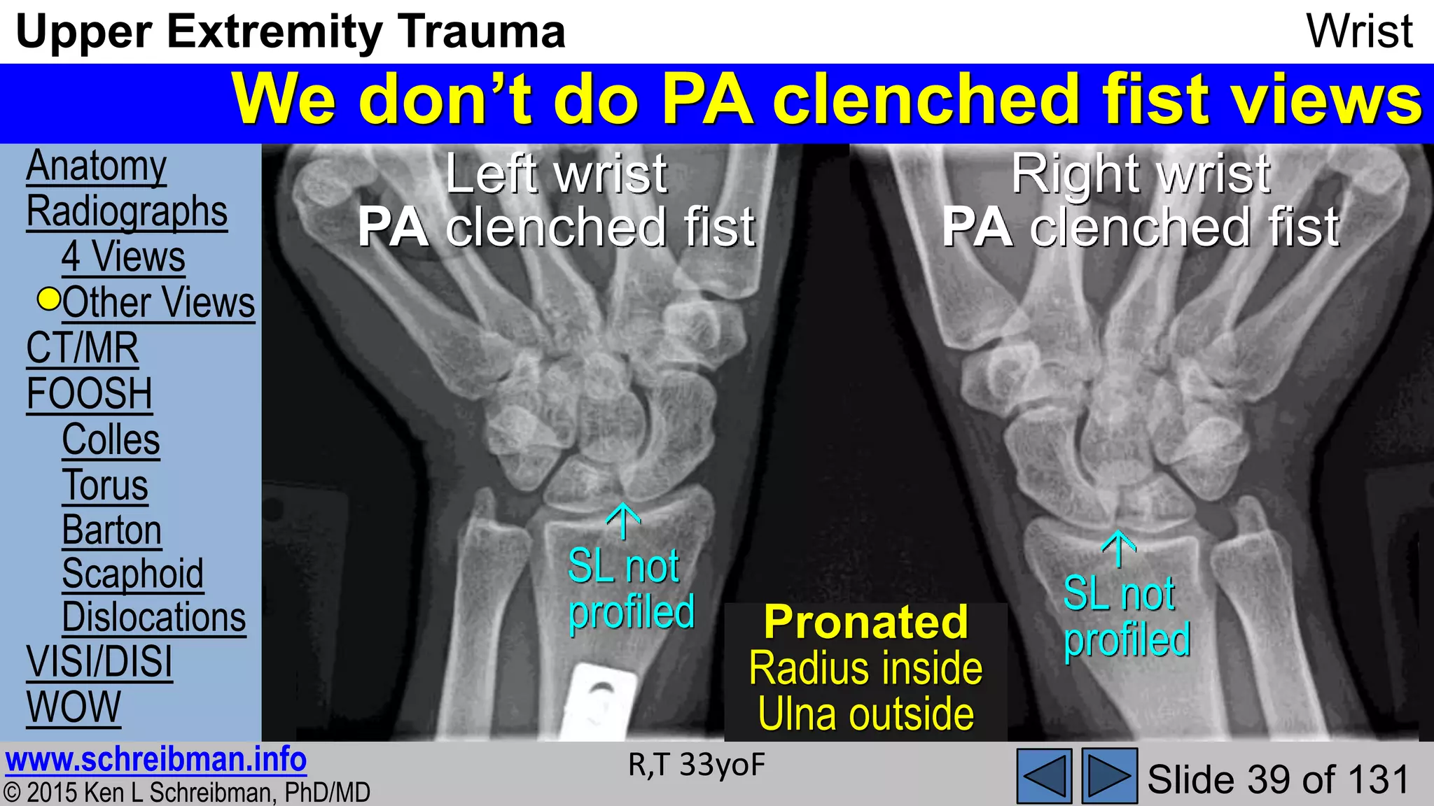 Upper Extremity Trauma Wrist complete MSK Radiology Lecture | PPT