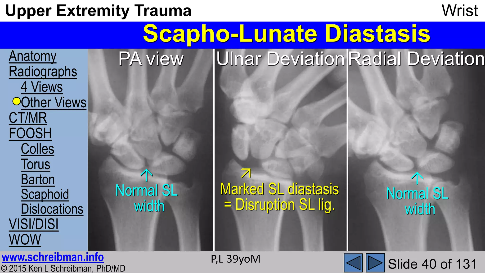 Upper Extremity Trauma Wrist complete MSK Radiology Lecture | PPT