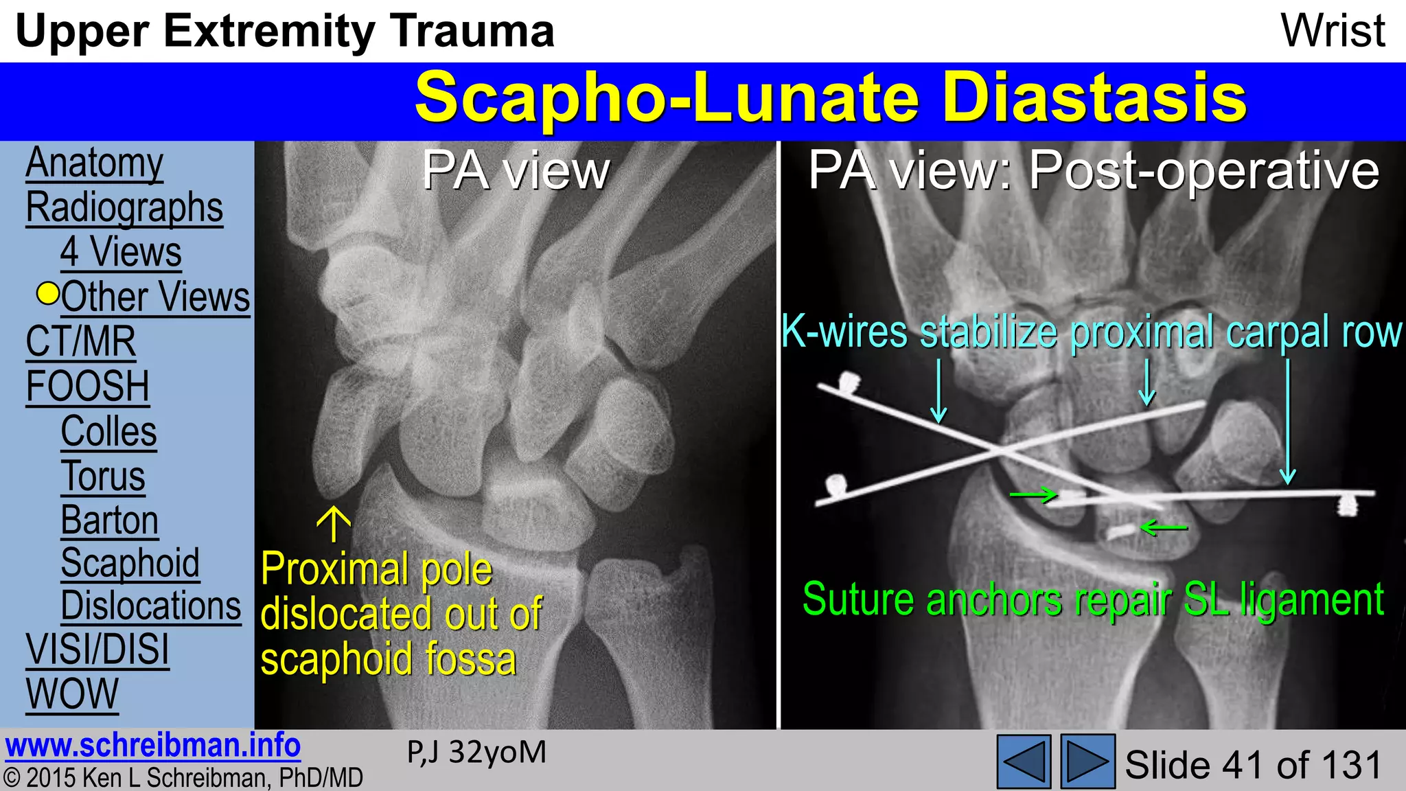 Upper Extremity Trauma Wrist complete MSK Radiology Lecture | PPT