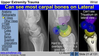 Upper Extremity Trauma Wrist complete MSK Radiology Lecture | PPSX