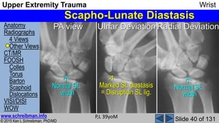 Upper Extremity Trauma Wrist complete MSK Radiology Lecture | PPSX