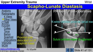 Upper Extremity Trauma Wrist complete MSK Radiology Lecture | PPSX