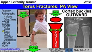 Upper Extremity Trauma Wrist complete MSK Radiology Lecture | PPSX