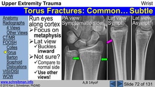 Upper Extremity Trauma Wrist complete MSK Radiology Lecture | PPSX