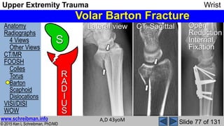 Upper Extremity Trauma Wrist complete MSK Radiology Lecture | PPSX