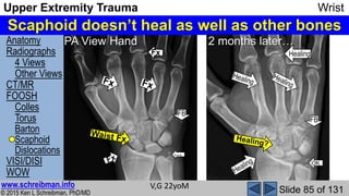 Upper Extremity Trauma Wrist complete MSK Radiology Lecture | PPSX