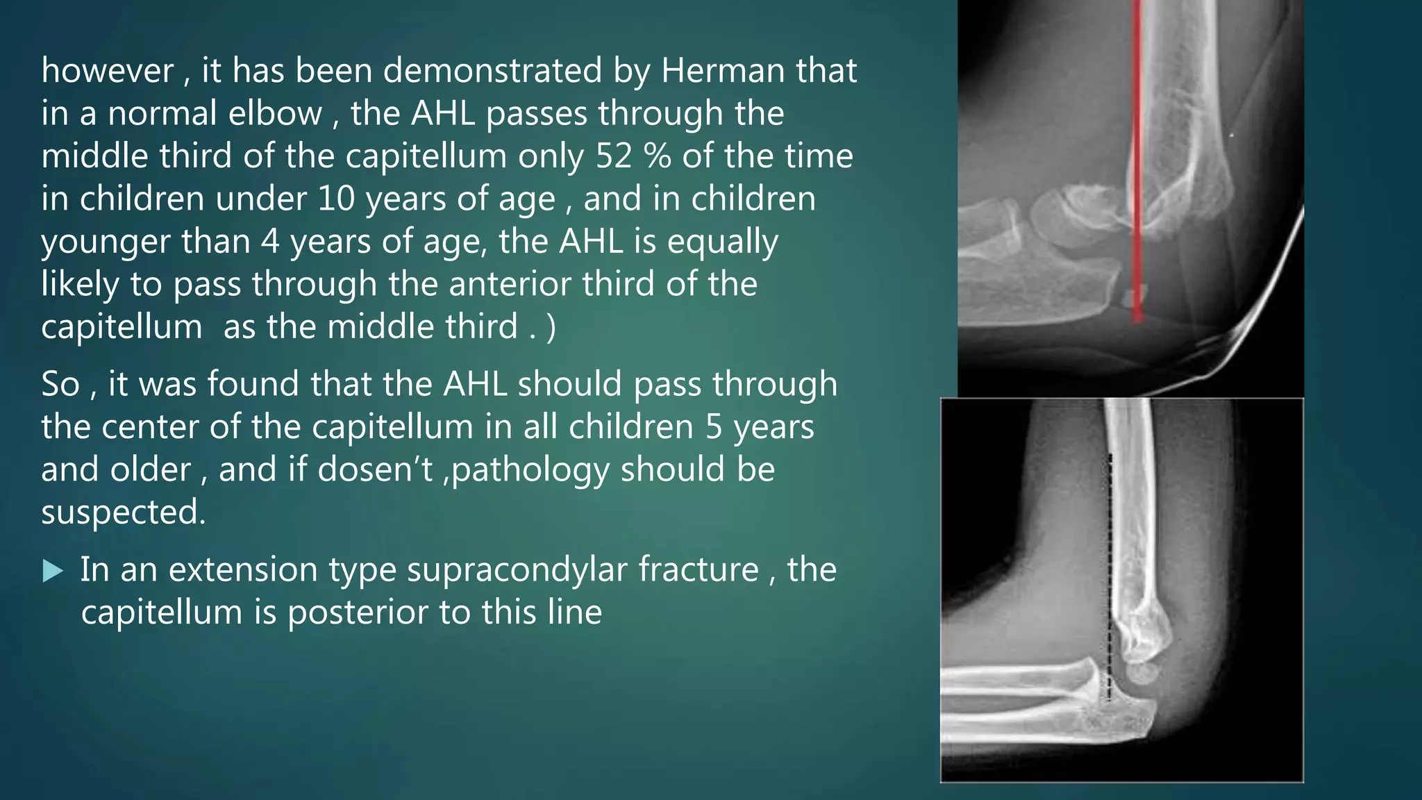 SCH- supracondylar humerus fracture in childrens | PPTX