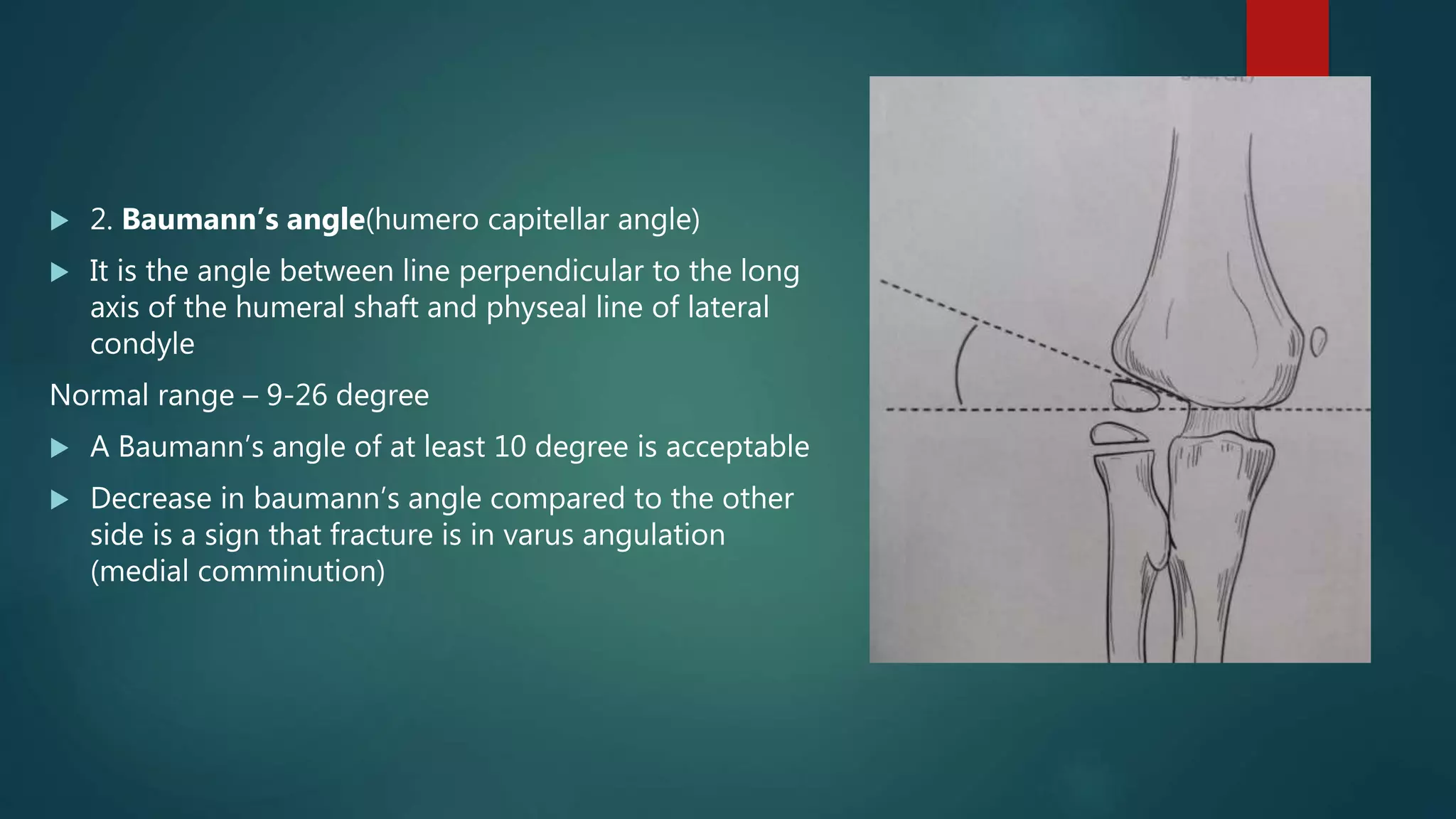 SCH- supracondylar humerus fracture in childrens | PPTX