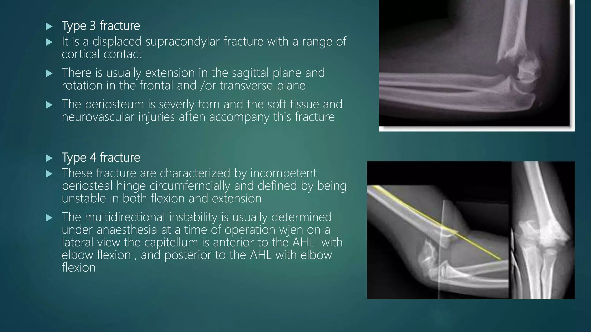 SCH- supracondylar humerus fracture in childrens | PPTX
