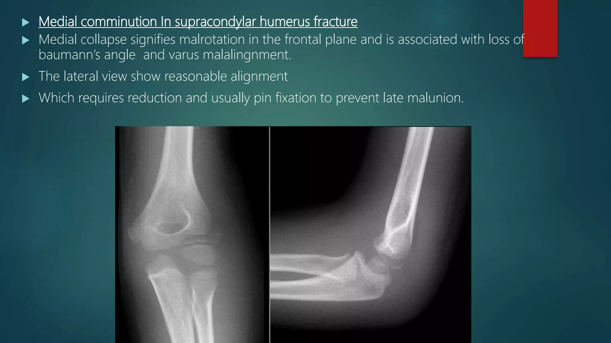 SCH- supracondylar humerus fracture in childrens | PPTX