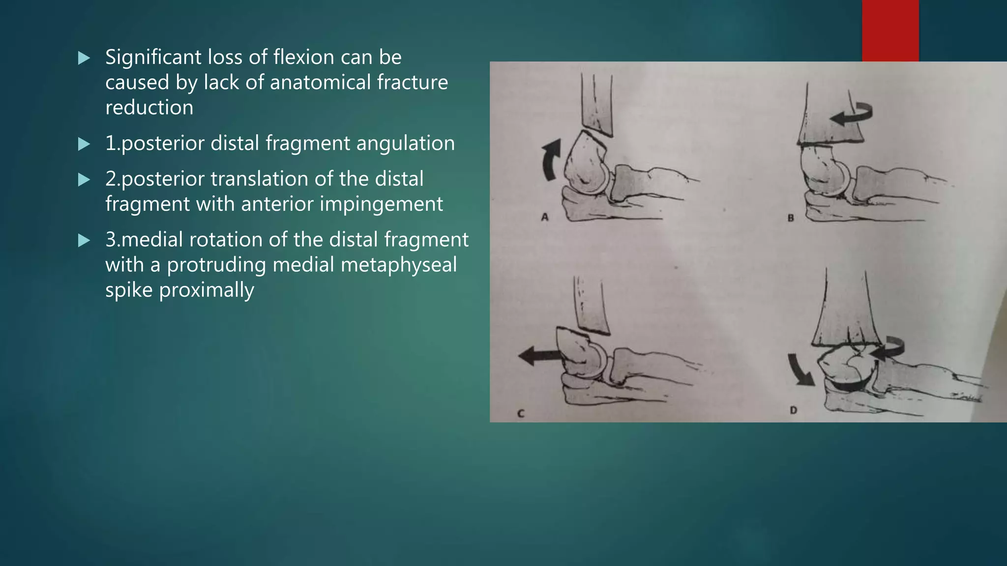 SCH- supracondylar humerus fracture in childrens | PPTX