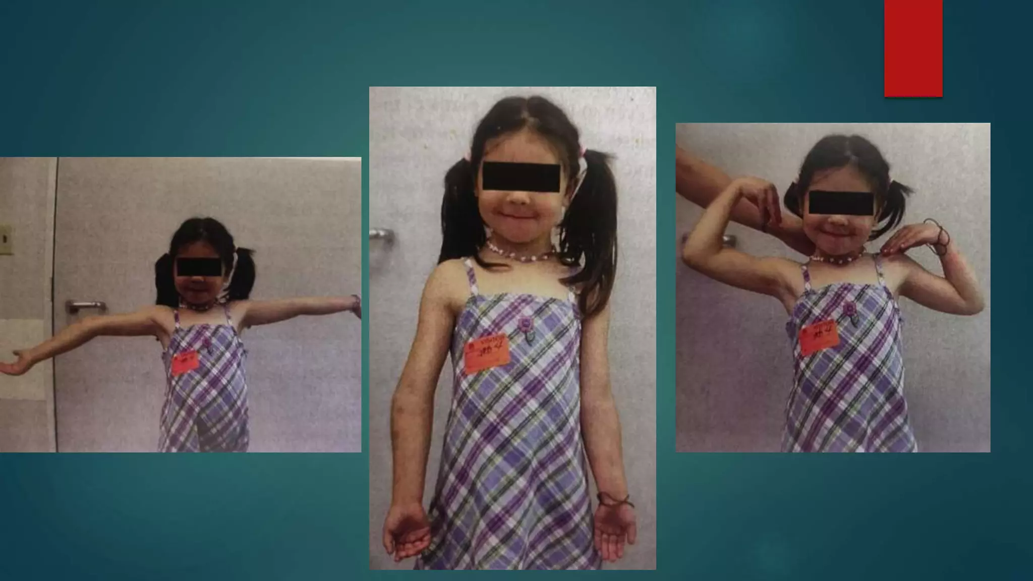 SCH- supracondylar humerus fracture in childrens | PPTX