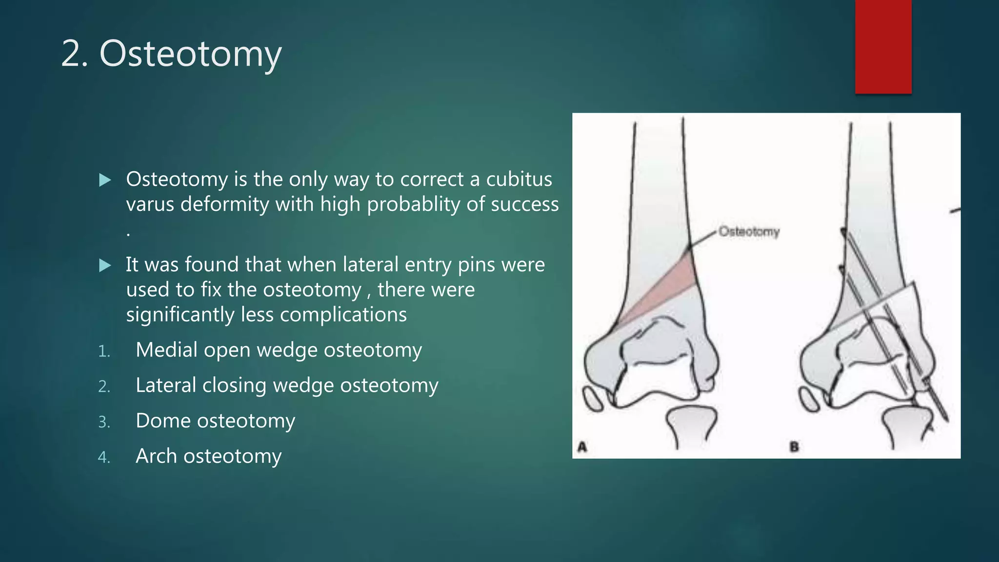 SCH- supracondylar humerus fracture in childrens | PPTX
