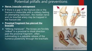 SCH- supracondylar humerus fracture in childrens | PPTX