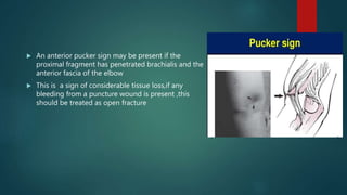 SCH- supracondylar humerus fracture in childrens | PPTX