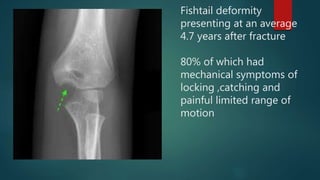 Fishtail Deformity Lateral Condyle Fracture