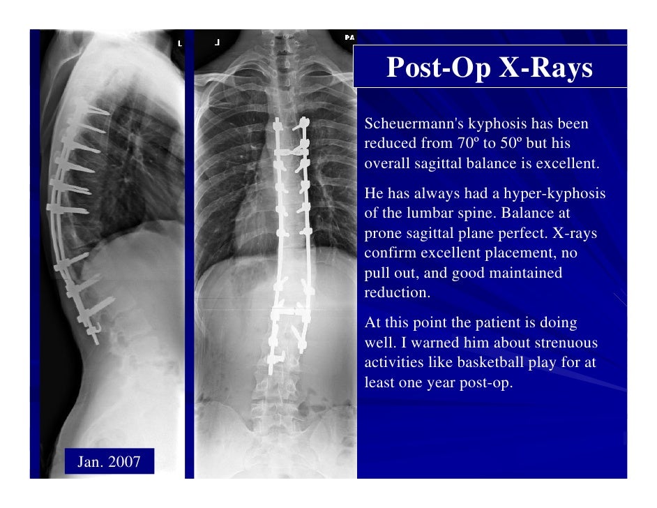 Schuermanns Kyphosis Surgery