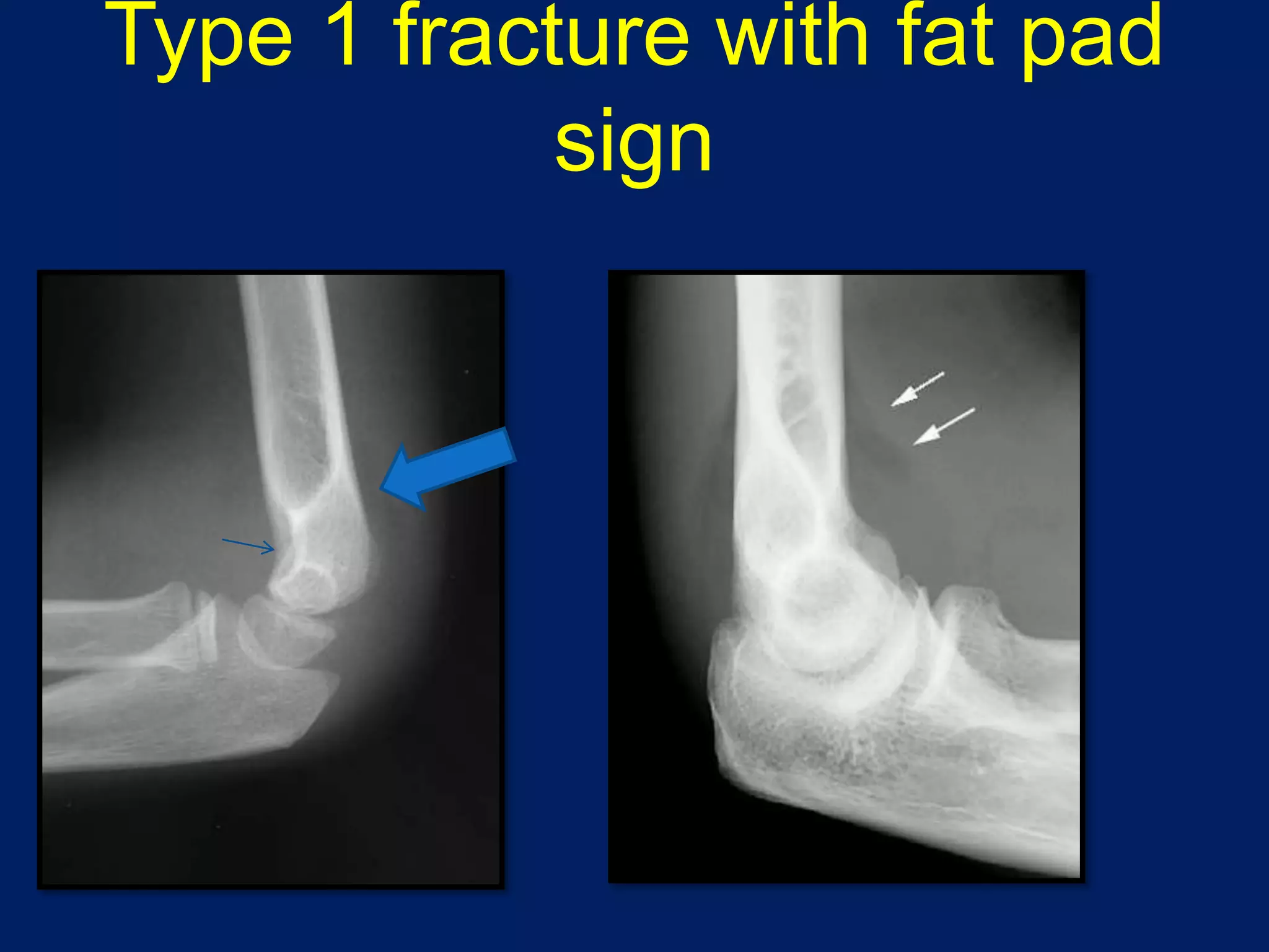 Sc humerus fractures in childrens by KRR | PPTX