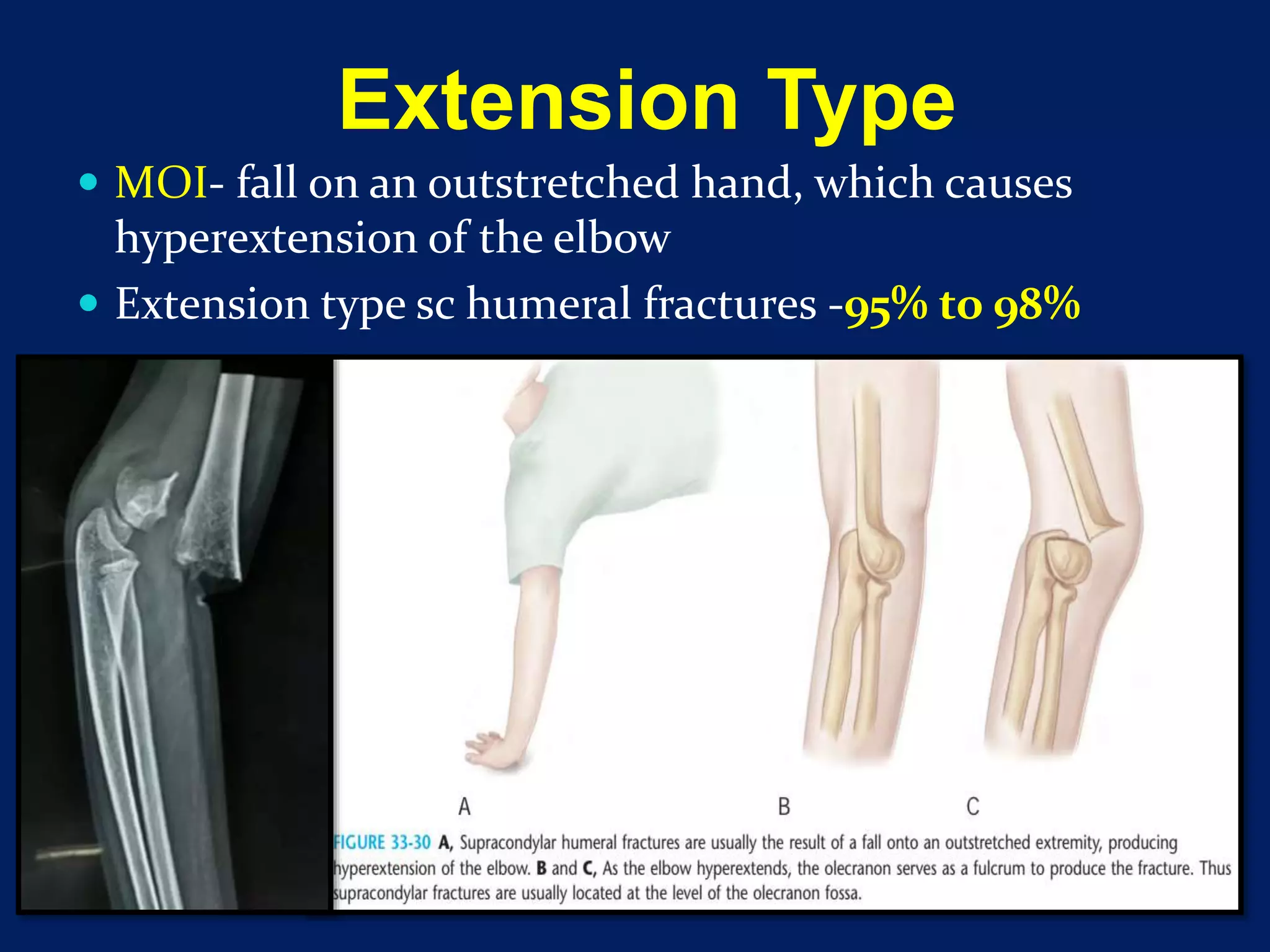 Sc humerus fractures in childrens by KRR | PPTX