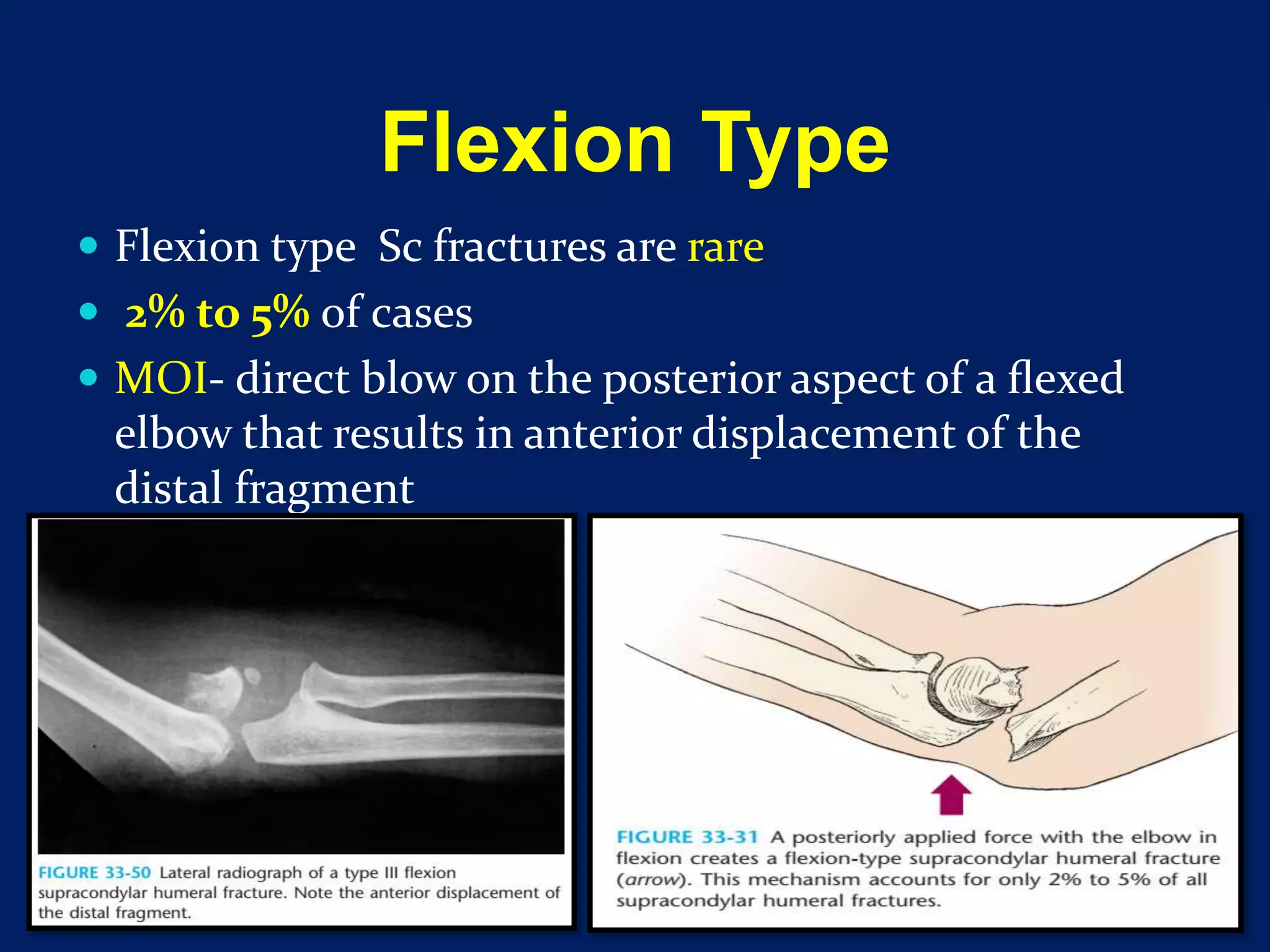Sc humerus fractures in childrens by KRR | PPTX
