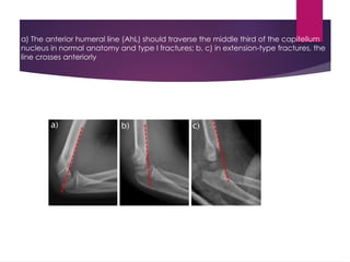 a brief summary of supracondylar humerus fractures (2).pptx