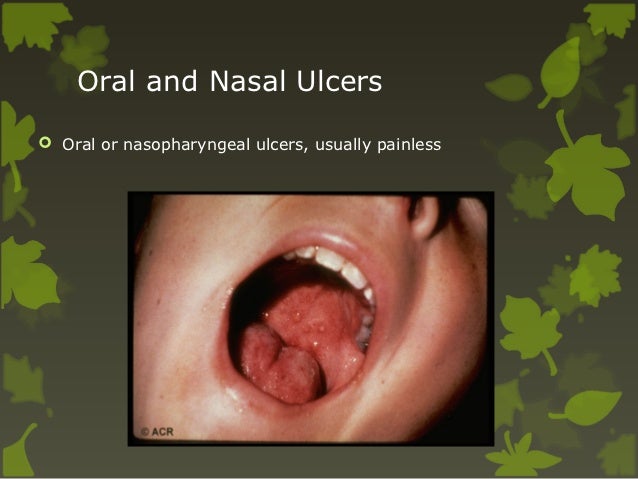 Get Into the Loop - Learn About Lupus