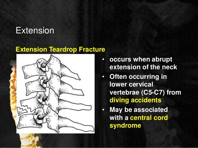 Flexion Vs Extension Teardrop Fracture