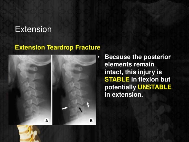 Flexion Vs Extension Teardrop Fracture