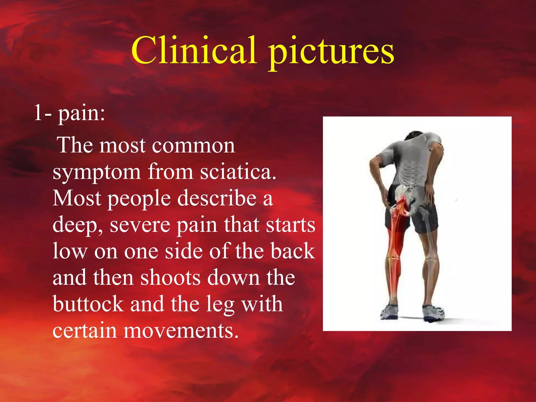 Sciatica | PPT