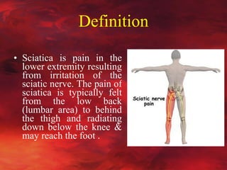 Sciatica | PPT